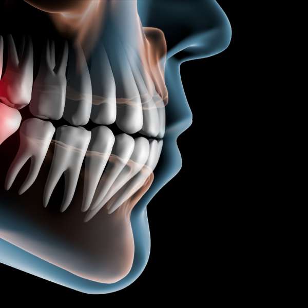 What are the different kinds of wisdom tooth impaction? | Greenlife Dental